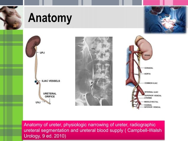OPTEK Lumbotomy proximal ureterolithotomy