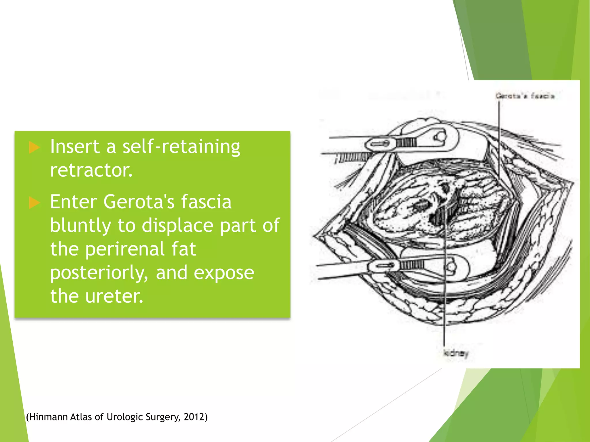 Lumbotomy- Proximal Ureterolithotomy.pptx