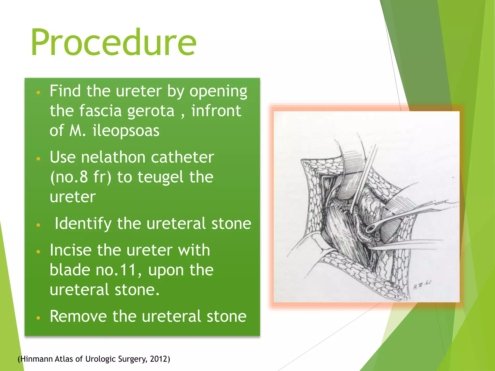 Lumbotomy- Proximal Ureterolithotomy.pptx