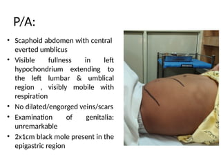 LUMP ABDOMEN (EHPVO- spleenomegaly).pptx