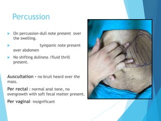 lump in abdomen (2).pptx