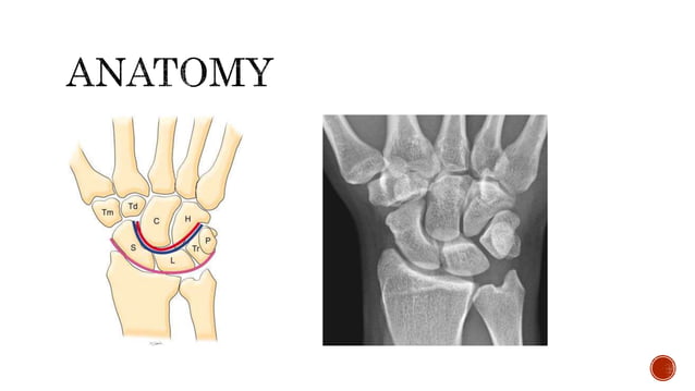 LUNATE DISLOCATION.power pointvelammal med college | PPT