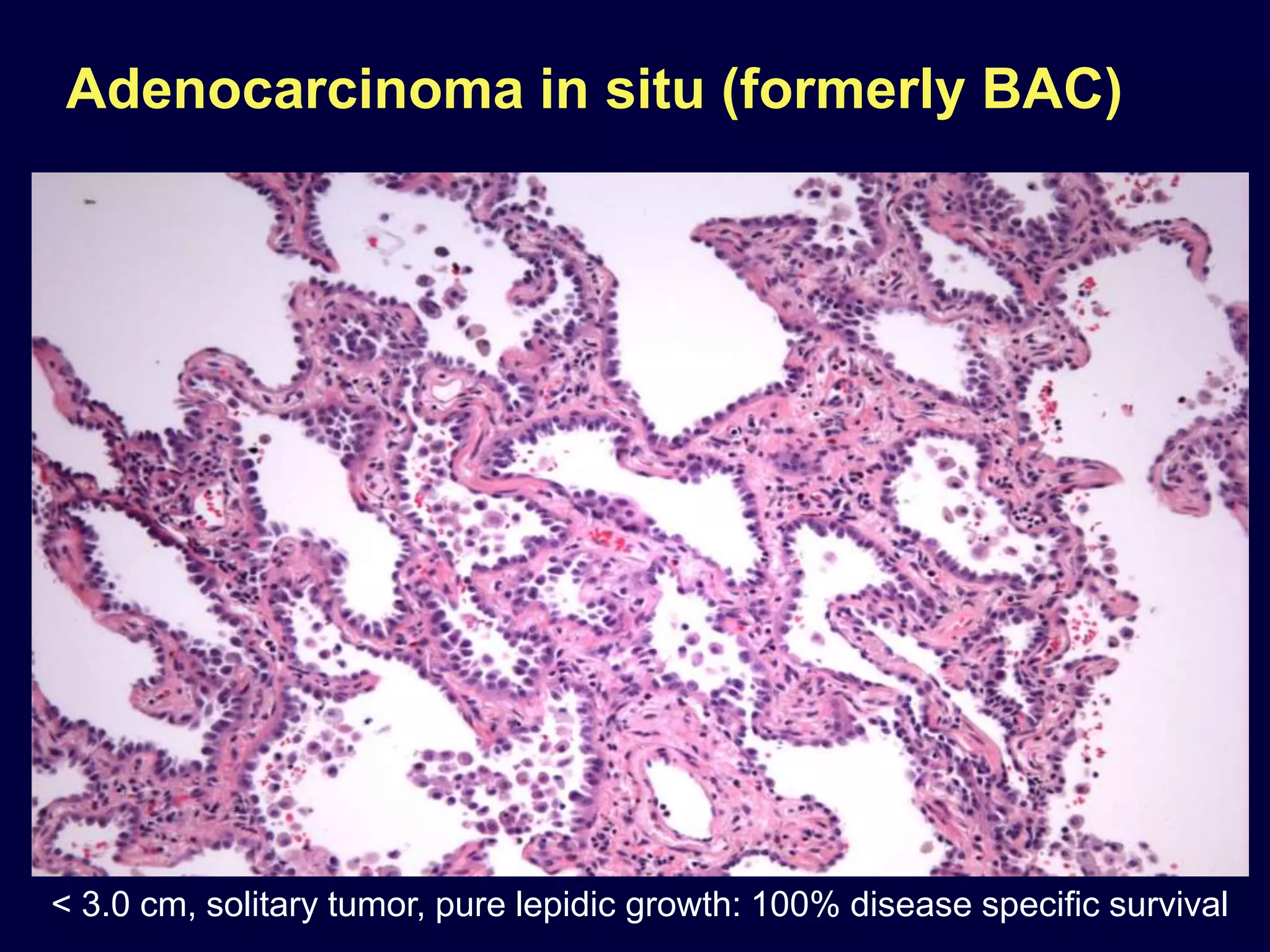 The IASLC Lung Cancer Staging Project: Proposals for the TNM Stage ...