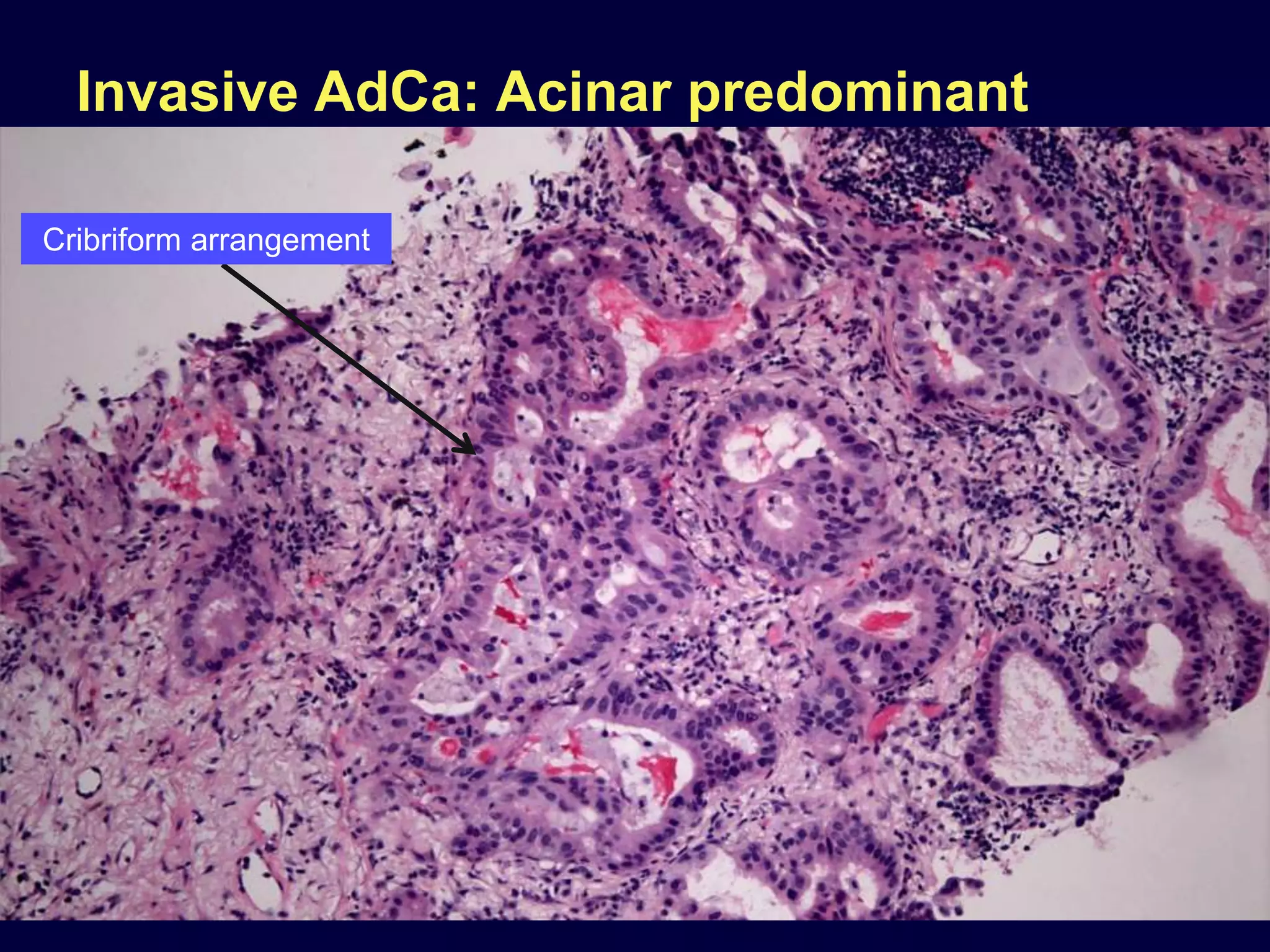 The IASLC Lung Cancer Staging Project: Proposals for the TNM Stage ...