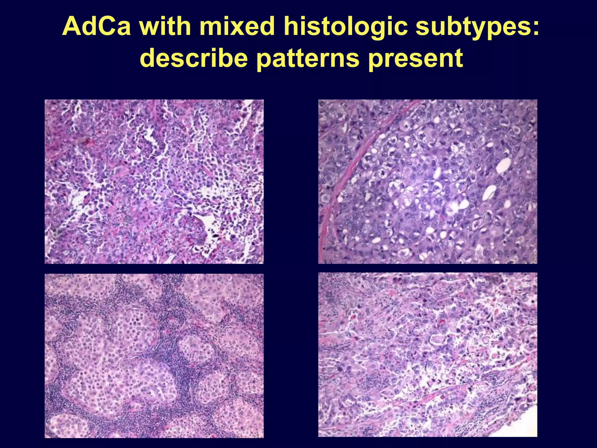 The IASLC Lung Cancer Staging Project: Proposals for the TNM Stage ...