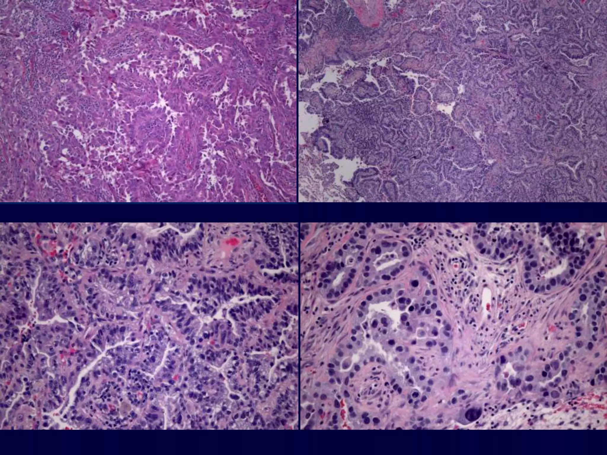 The IASLC Lung Cancer Staging Project: Proposals for the TNM Stage ...