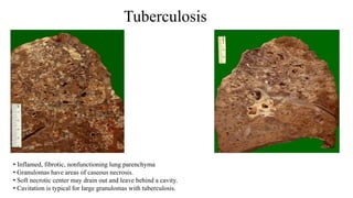 lung- Gross &Microscopy | PPT