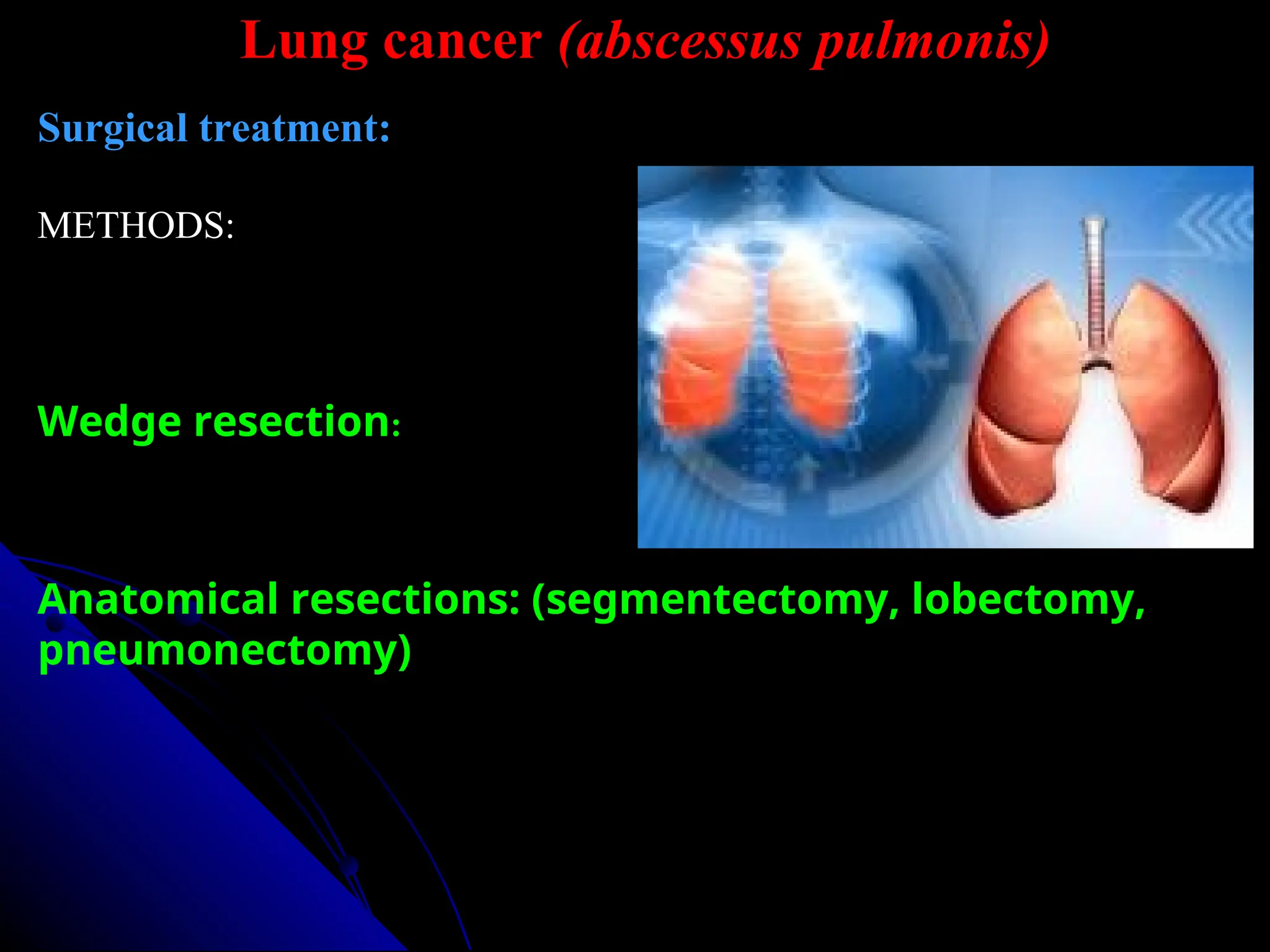 lung-abscess. Dr ibrahimi md pulmonologist.ppt