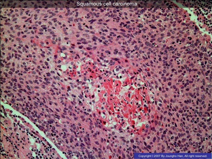 Lung Cancer Squamous Cell Carcinoma