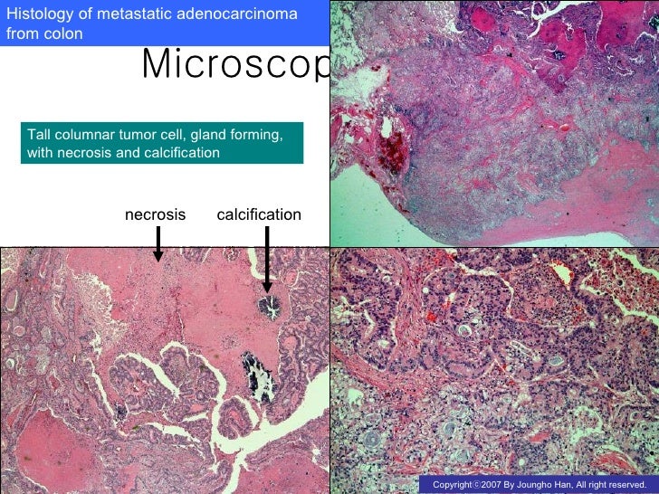 Lung Metastatic Adenocarcinoma From Colon