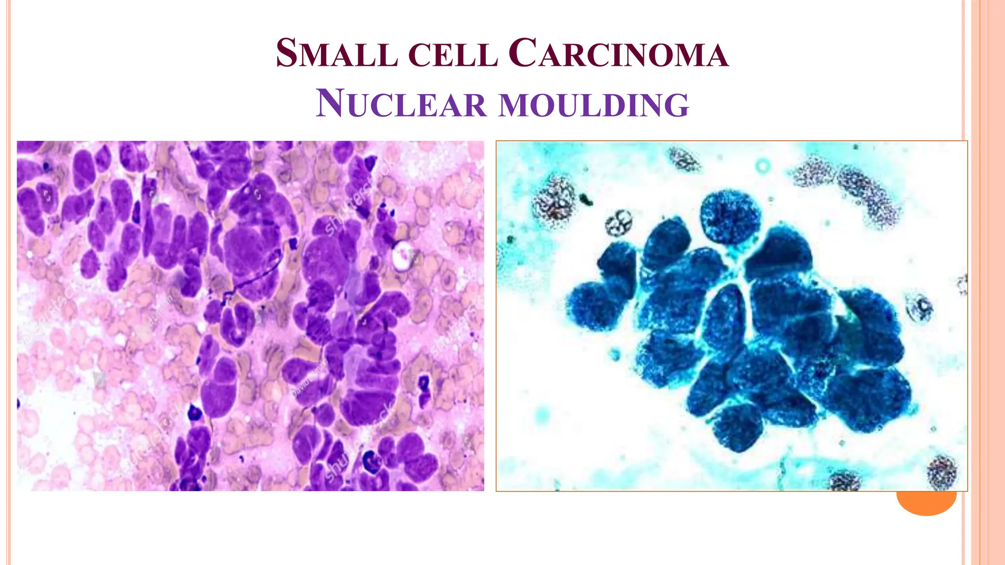 lung-tumors.ppt