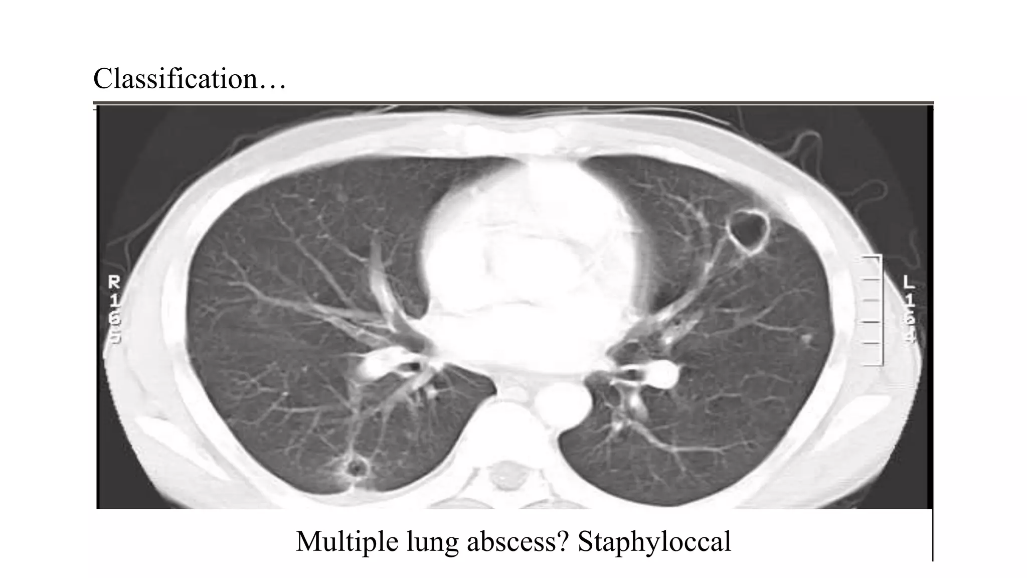 Lung abscess | PPTX
