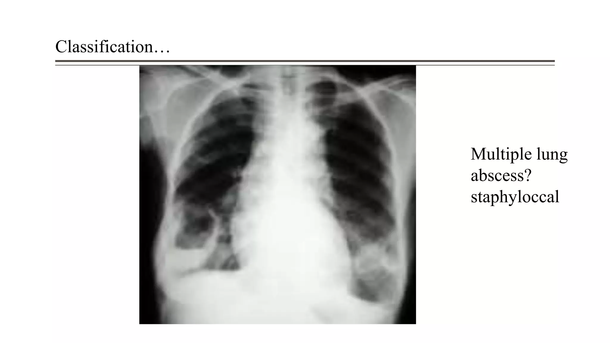 Lung abscess | PPTX