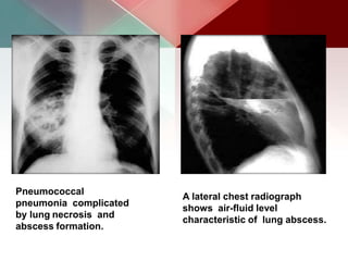 Lung abscess | PPTX