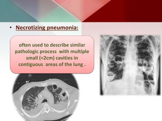 Lung abscess | PPTX