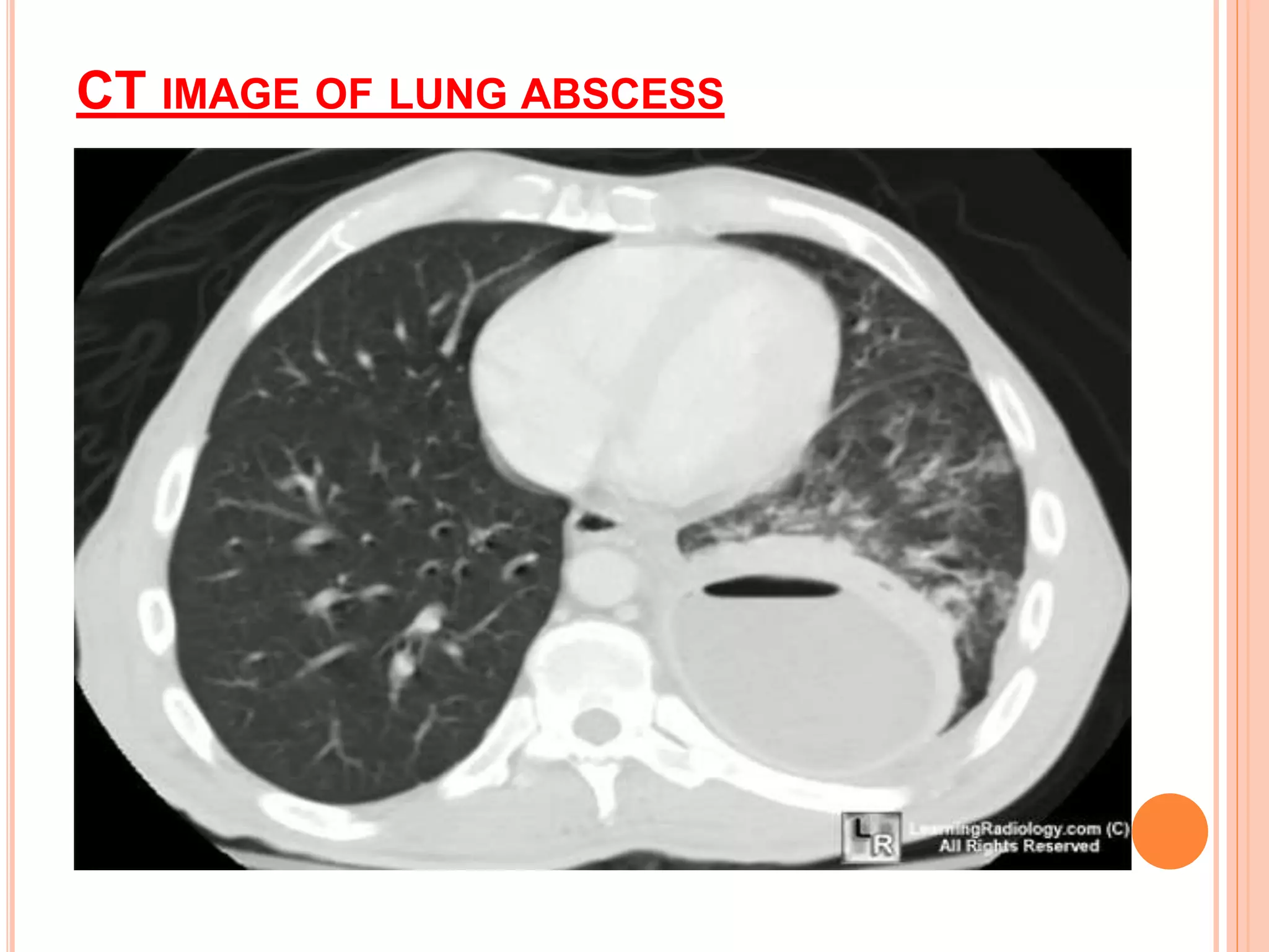 Lung abscess & Nursing care | PPTX