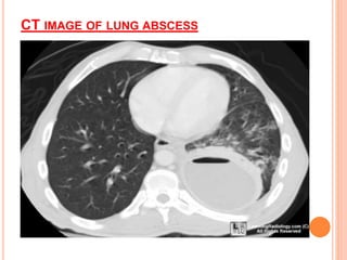 Lung abscess & Nursing care | PPTX
