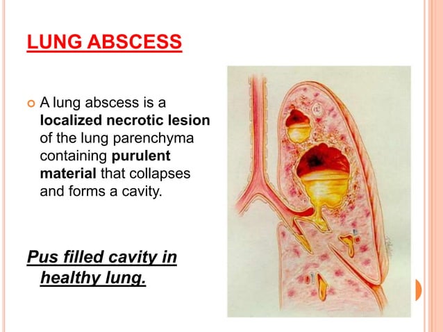 Lung abscess & Nursing care | PPT | Free Download