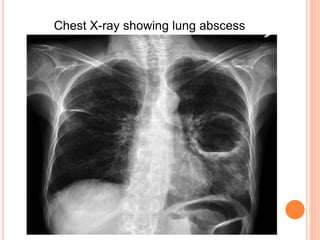 Lung abscess & Nursing care | PPTX