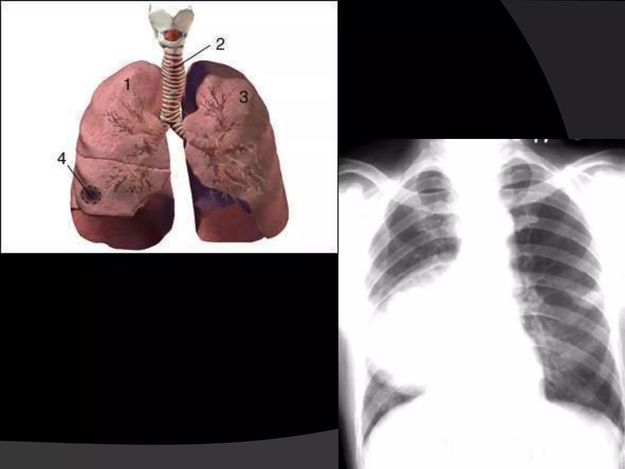 Lung abscess | PPTX