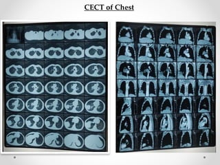 Fever with cough and chest pain. | PPT