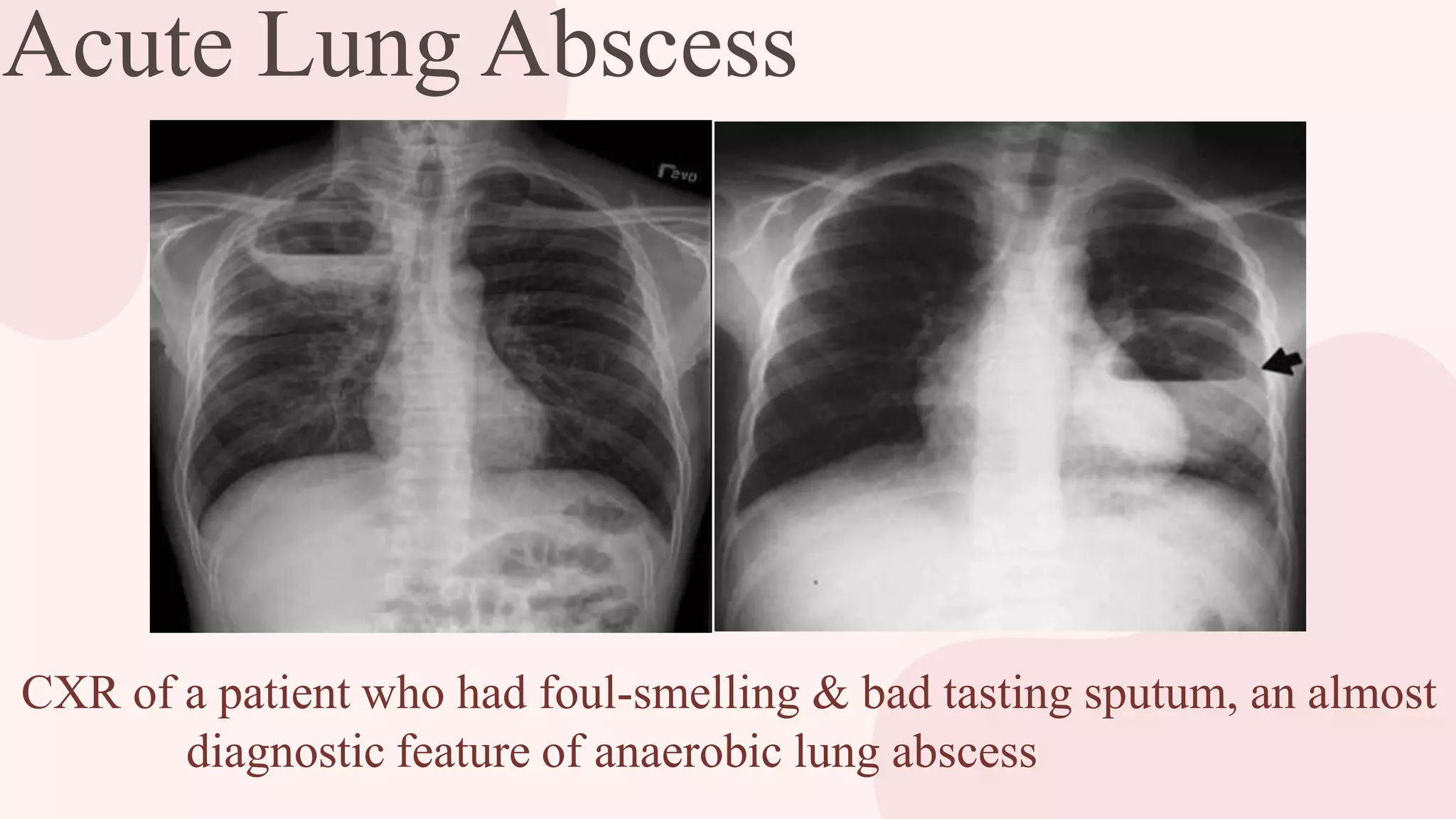 LUNG ABSCESS.pptx | Lung and Respiratory Health | Diseases and Conditions