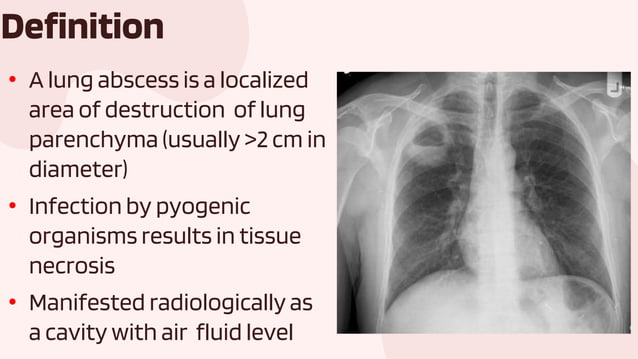 LUNG ABSCESS.pptx | Lung and Respiratory Health | Diseases and Conditions