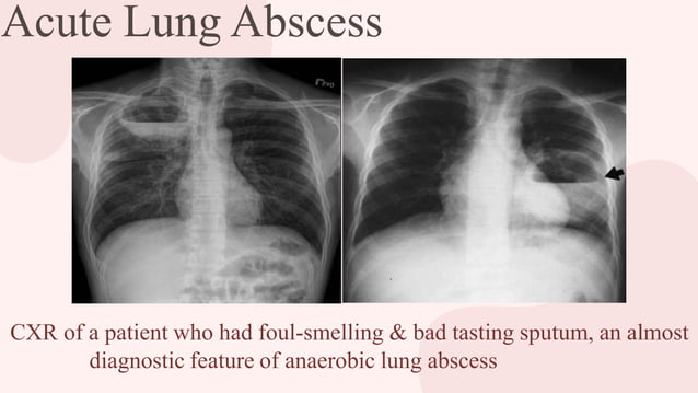 LUNG ABSCESS.pptx | Lung and Respiratory Health | Diseases and Conditions