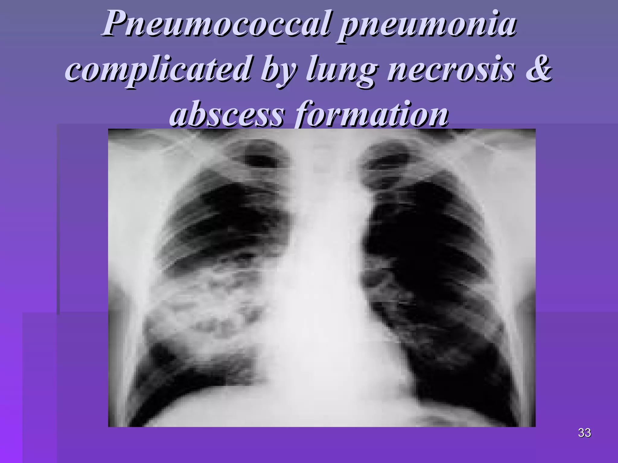 LUNG ABSCESS.pdf