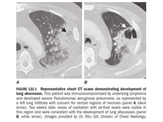 Lung Abscess.pptx for medical students.. | PPT