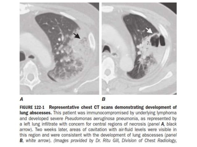 Lung Abscess.pptx for medical students.. | PPT