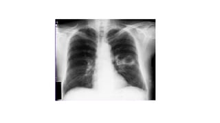 lung abscess-types, clinical features, treatment | PPTX