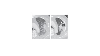 lung abscess-types, clinical features, treatment | PPTX