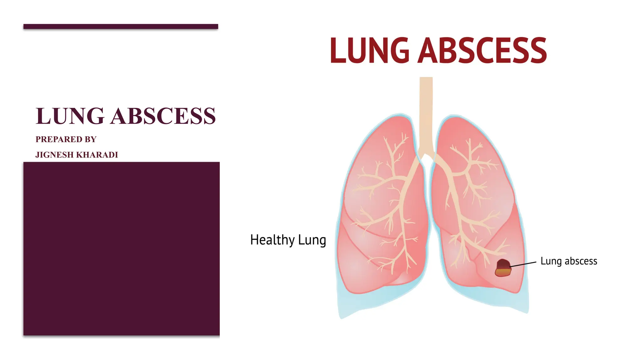 Lung abscess.pptx (pathological process) | PPTX