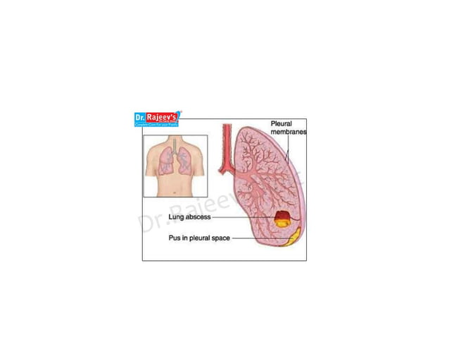 Lung abscess medical surgical Nursing.pptx