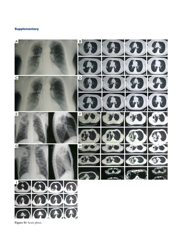 Lung abscess-etiology, diagnostic and treatment options-2015.pdf | Lung and Respiratory Health ...