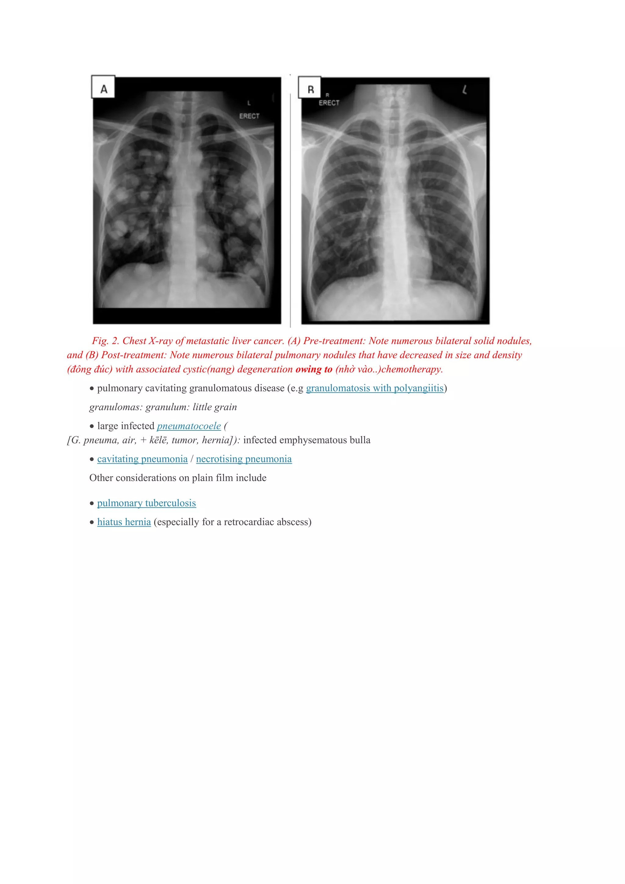 Lung abscess pdf | PDF