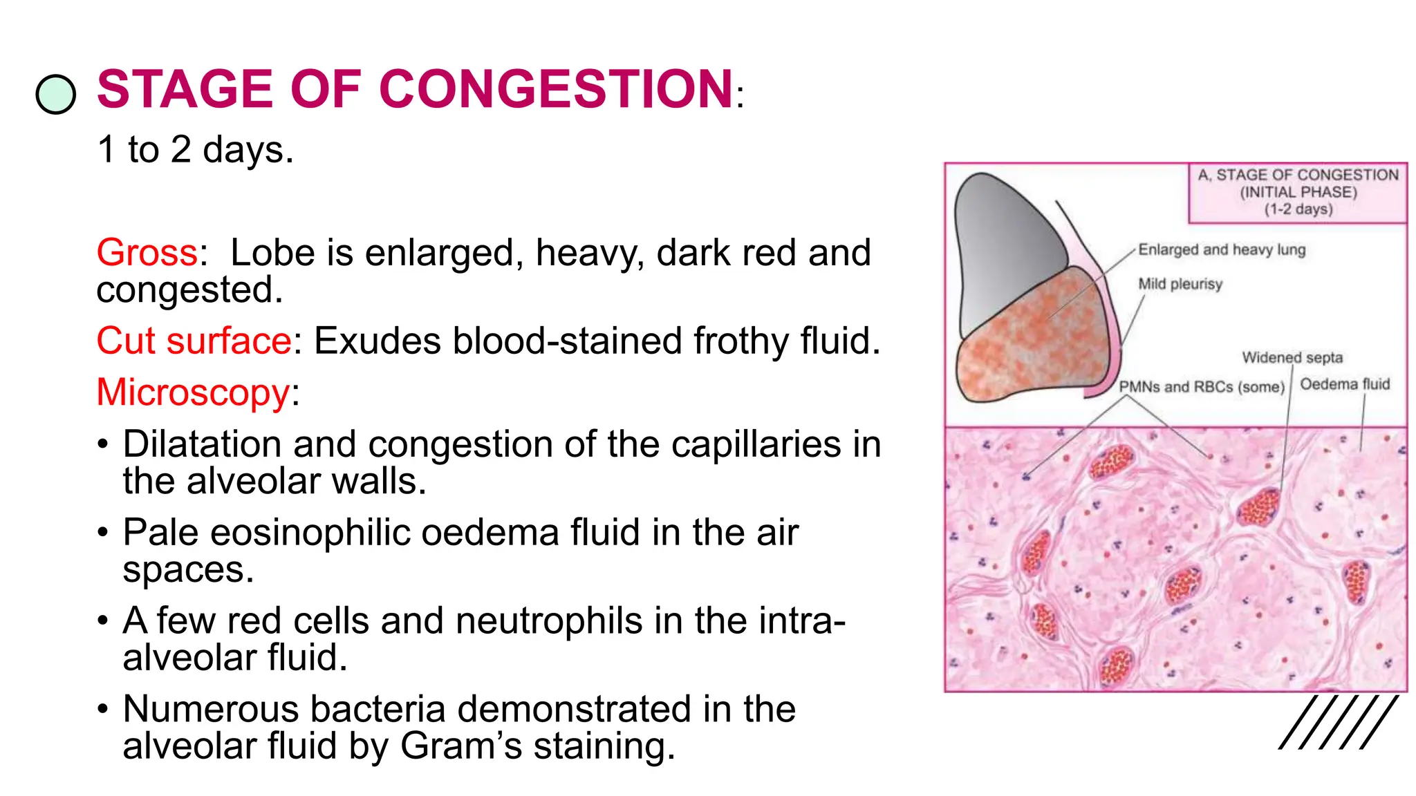 Lung Abscess and Pneumonia (Pathology) | PPTX