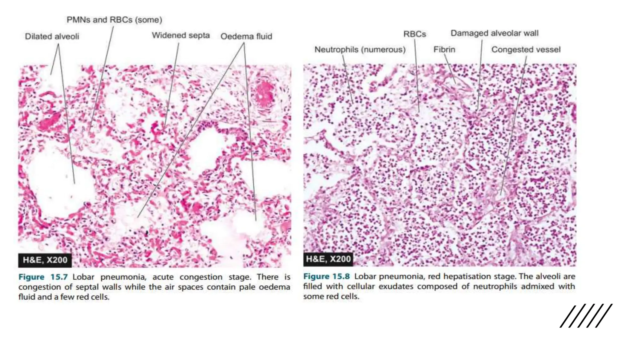 Lung Abscess and Pneumonia (Pathology) | PPTX