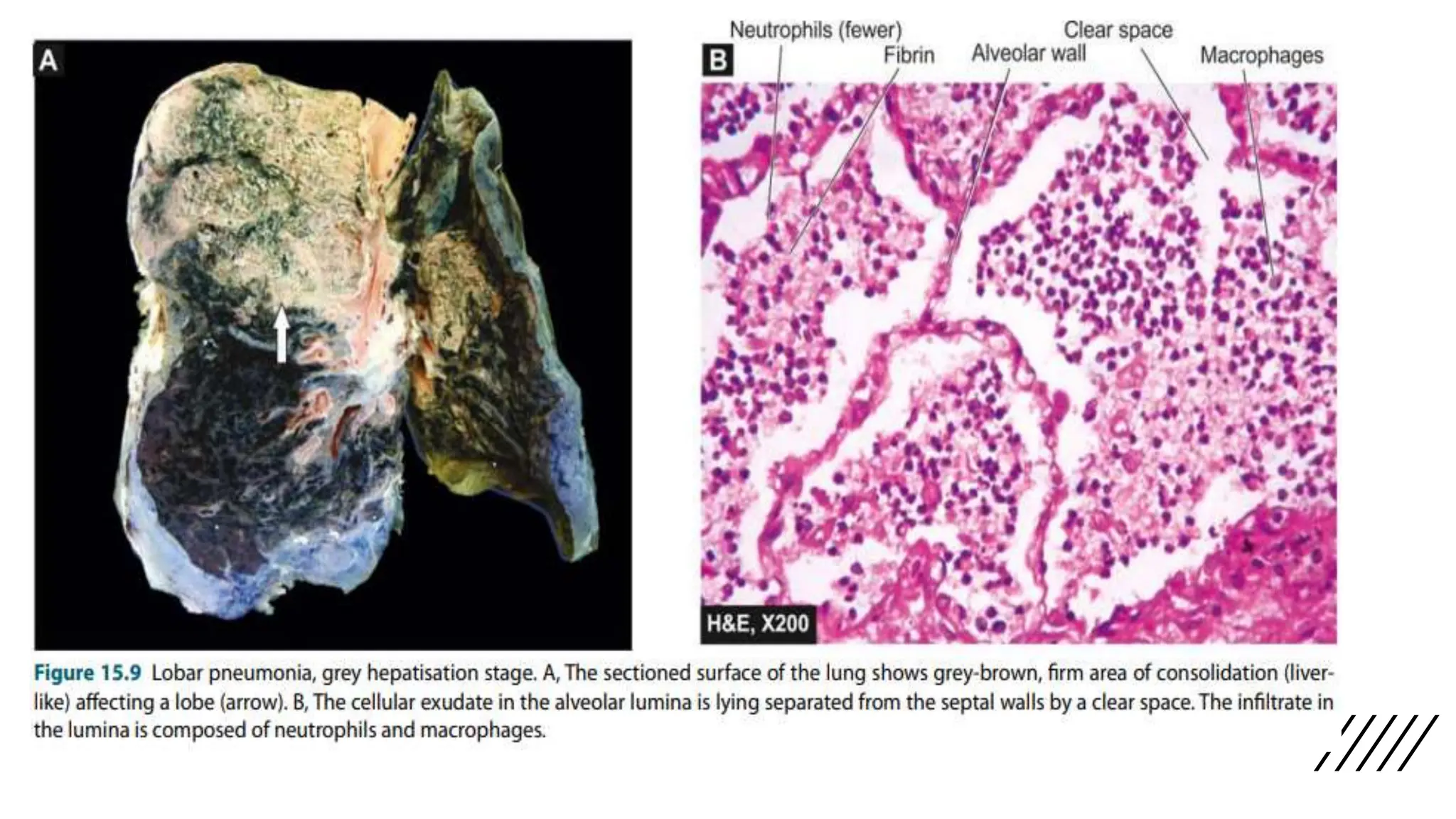 Lung Abscess and Pneumonia (Pathology) | PPTX