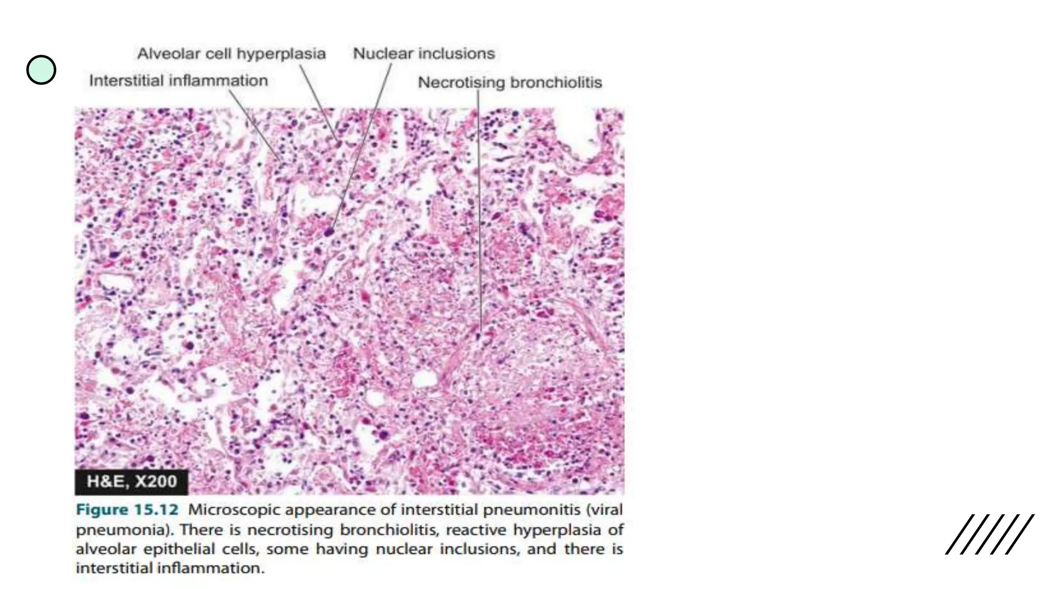 Lung Abscess and Pneumonia (Pathology) | PPTX