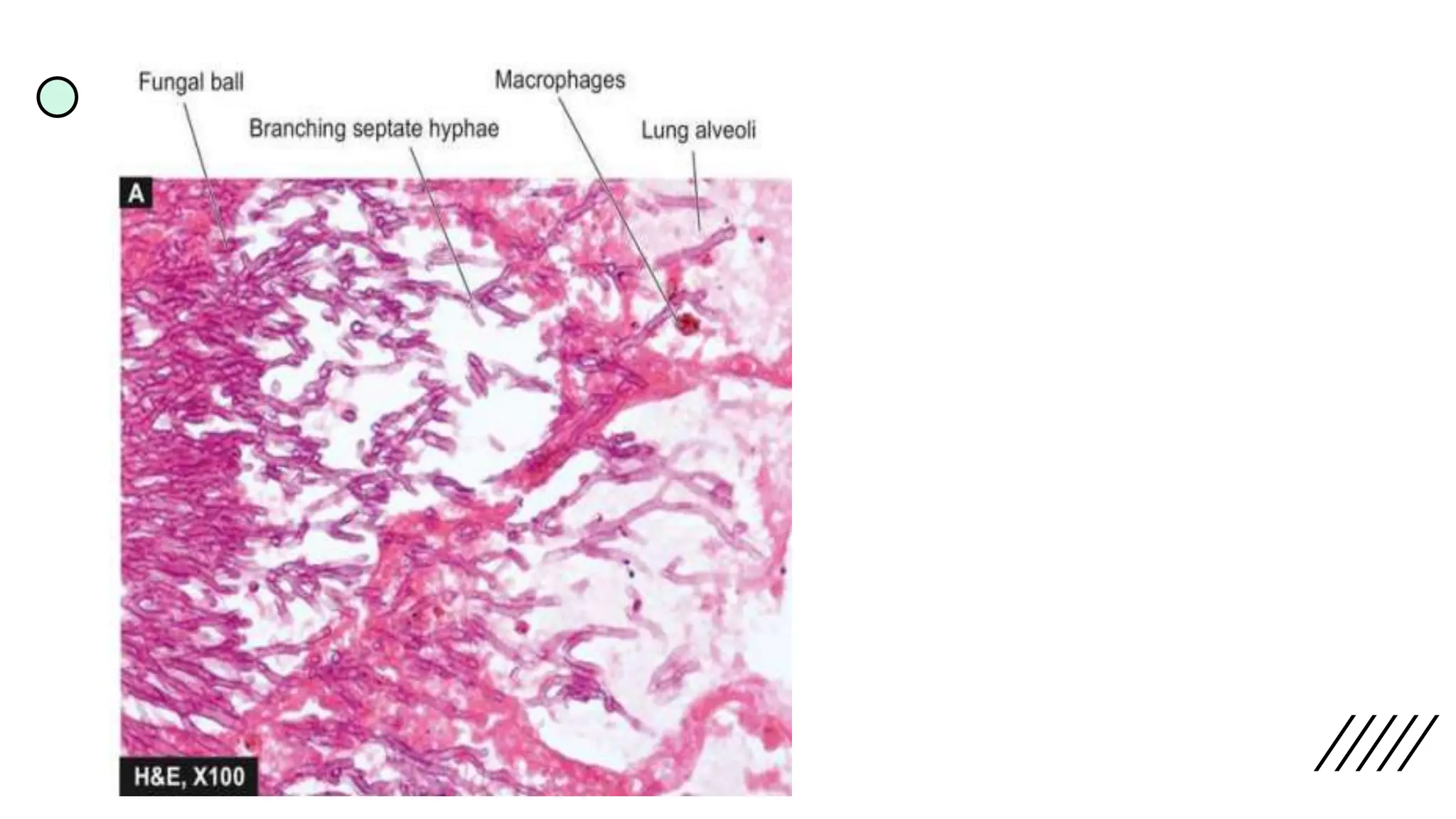 Lung Abscess and Pneumonia (Pathology) | PPTX