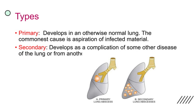 Lung Abscess and Pneumonia (Pathology) | PPTX