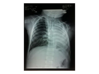 Lung agenesis | PPTX