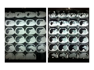 Lung agenesis | PPTX