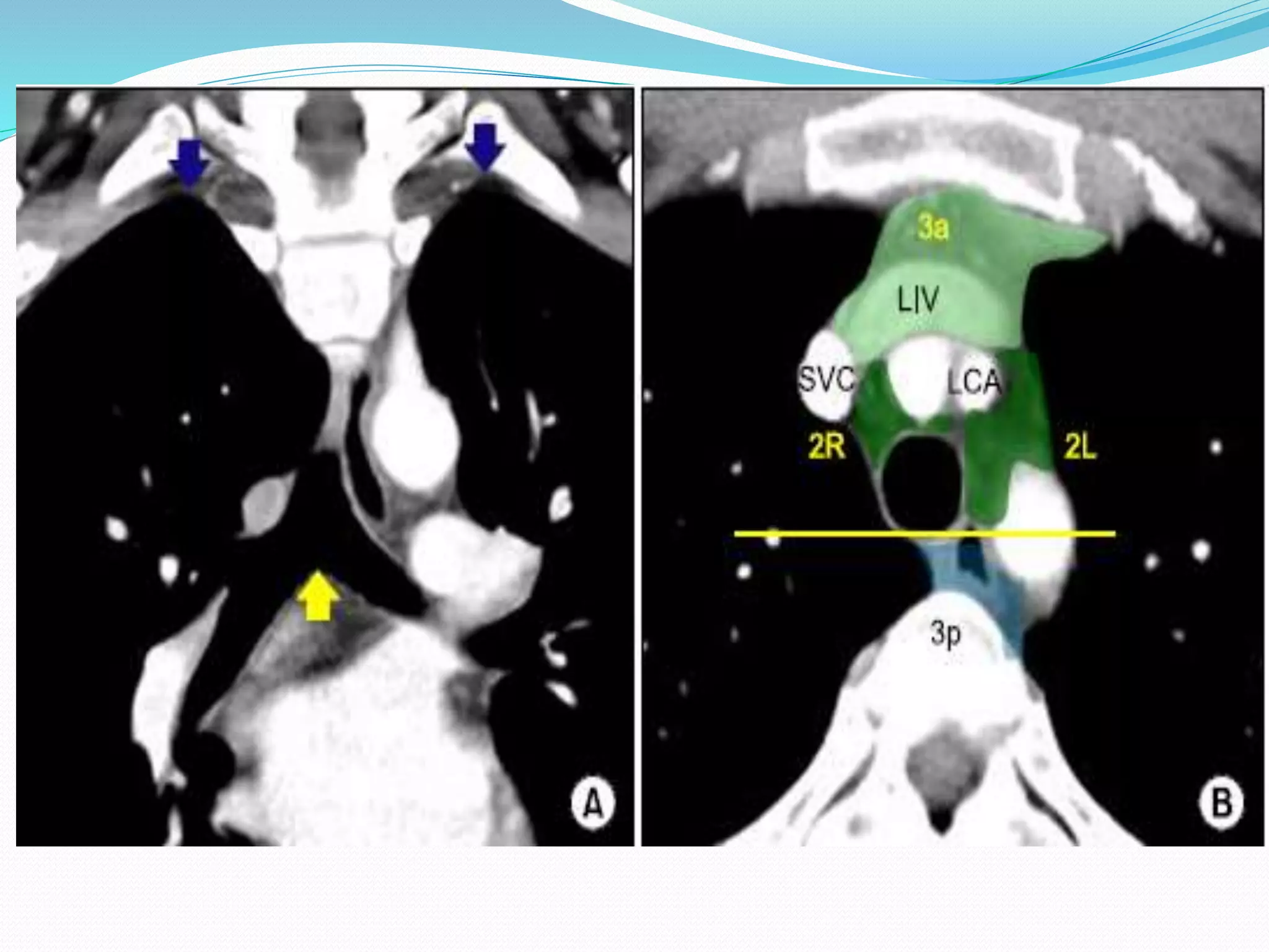 Lymph nodal stations in ca lung | PPTX