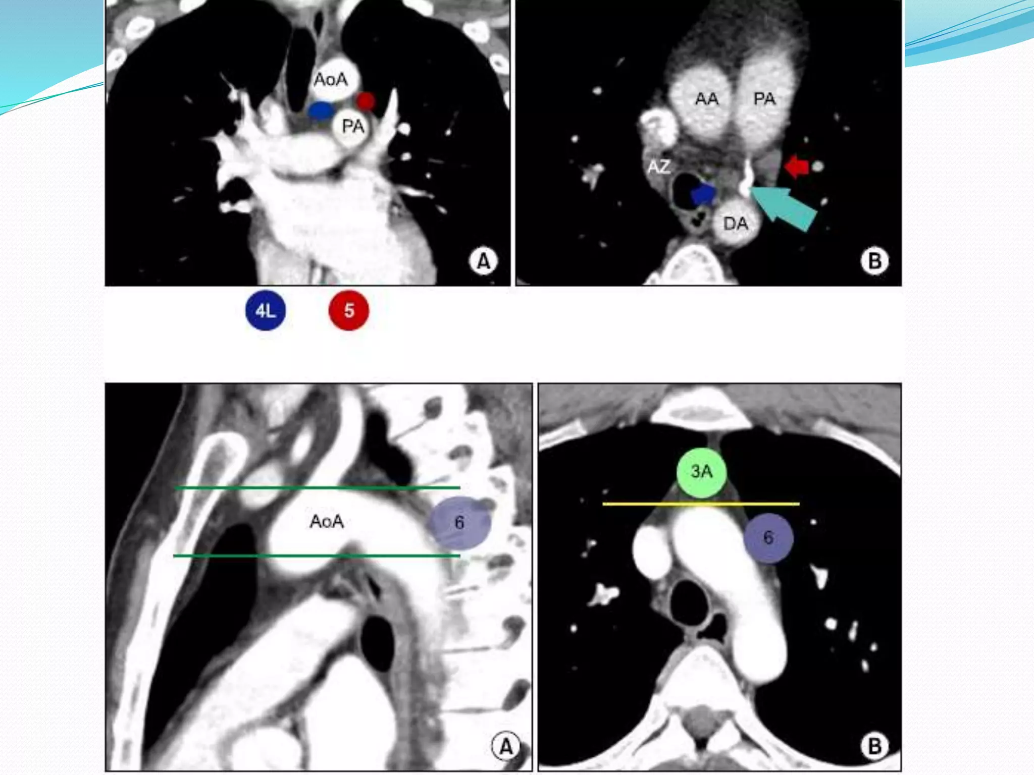 Lymph nodal stations in ca lung | PPTX