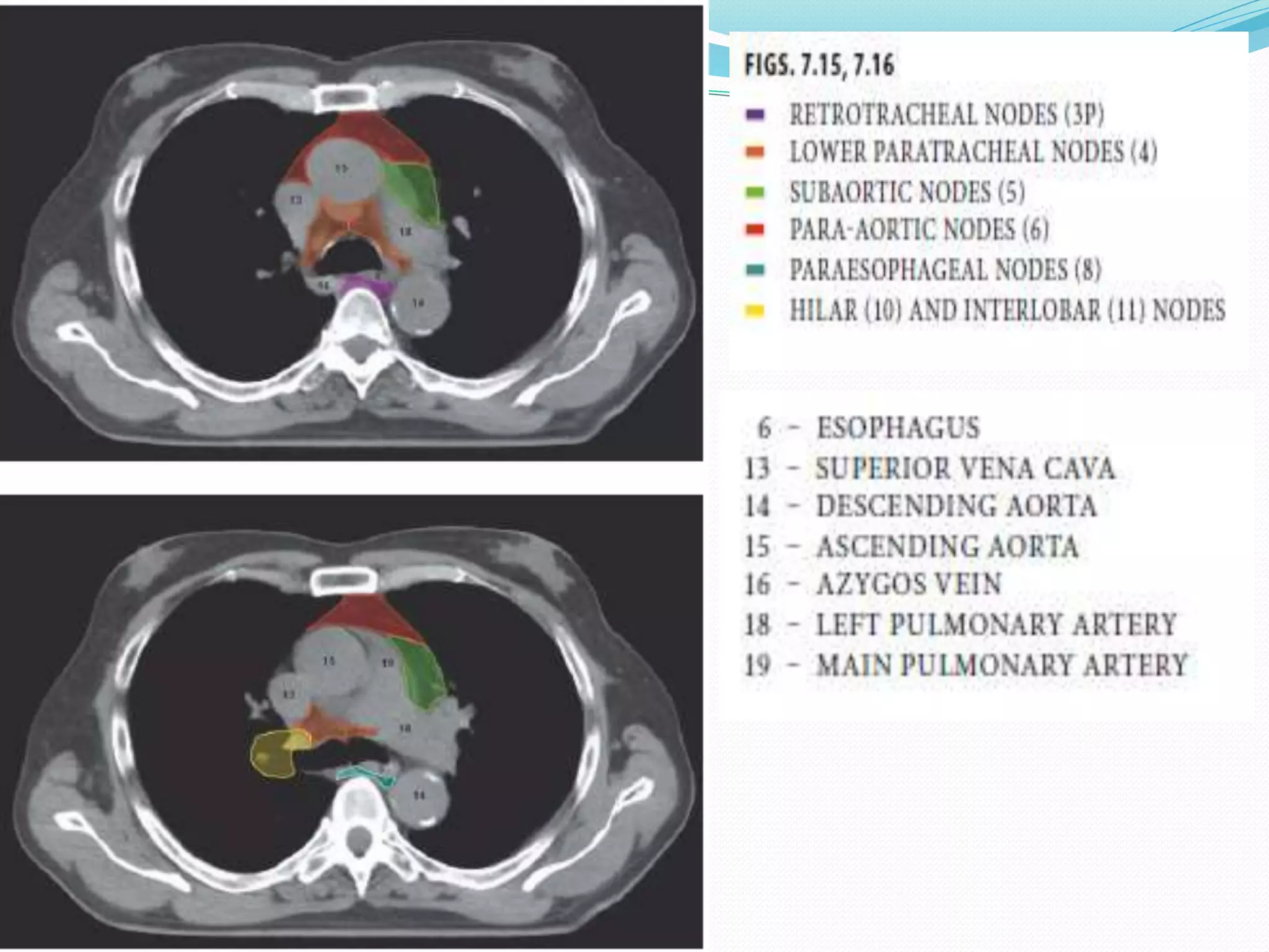 Lymph nodal stations in ca lung | PPTX