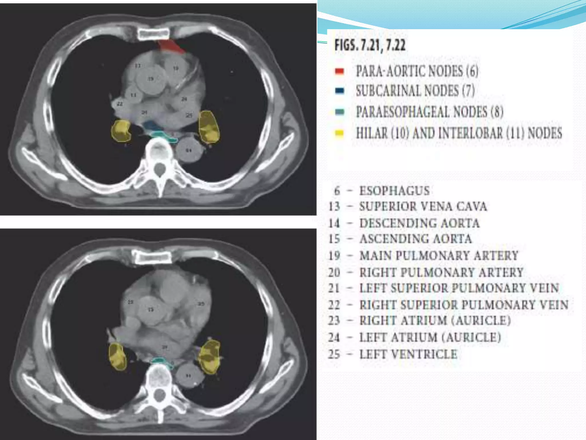Lymph nodal stations in ca lung | PPTX