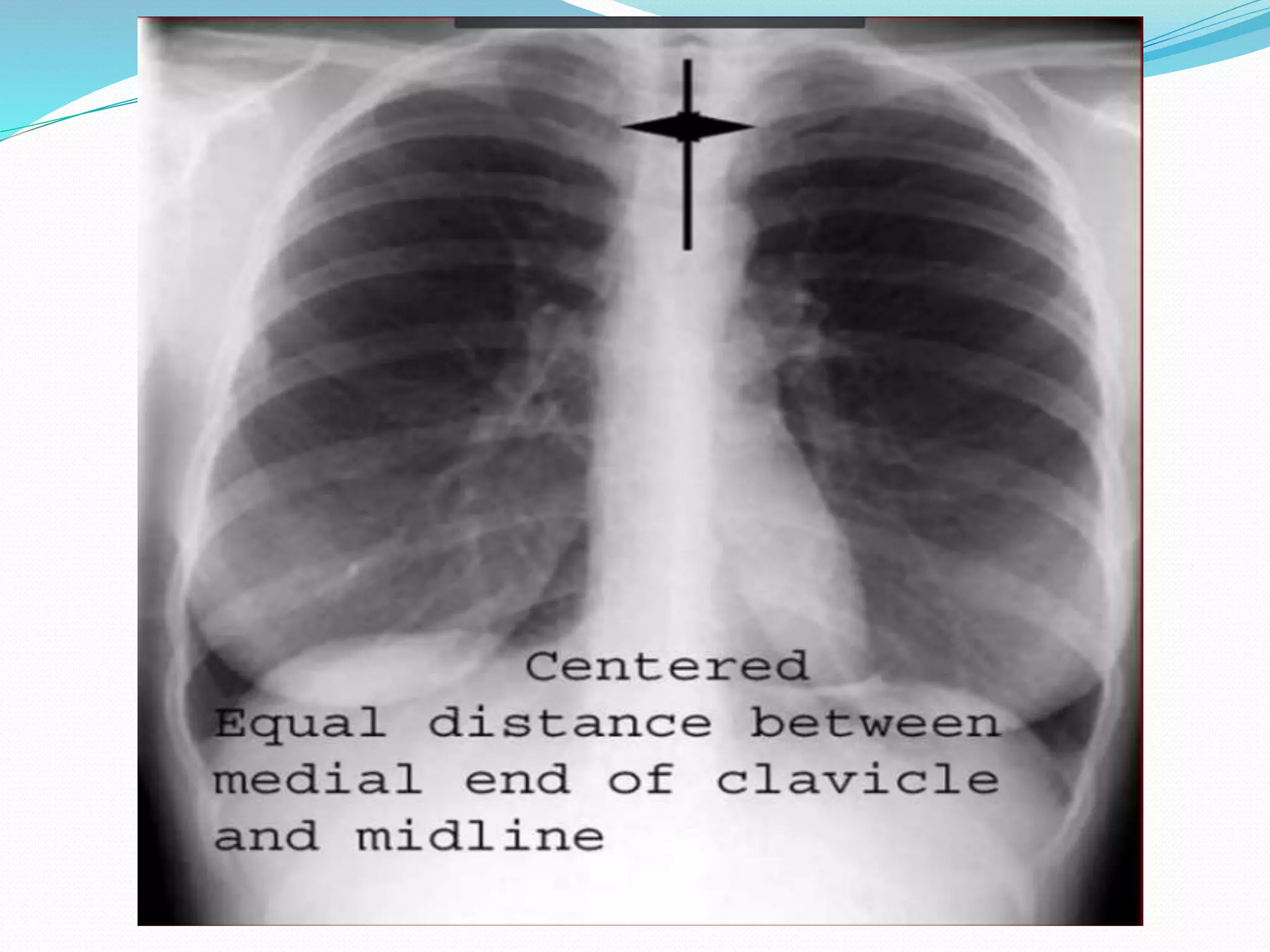 Lymph nodal stations in ca lung | PPTX